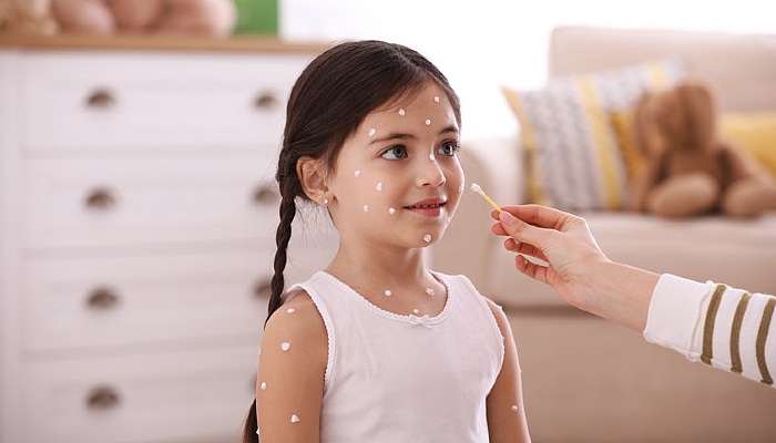 אדמת או אבעבועות רוח – במה מהם התינוק שלי חולה?