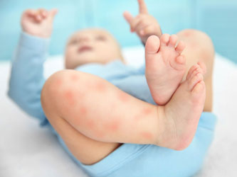 עקיצת יתוש - המדריך המלא שיעזור לכם להתמודד עם התסמינים | טיפטיפות